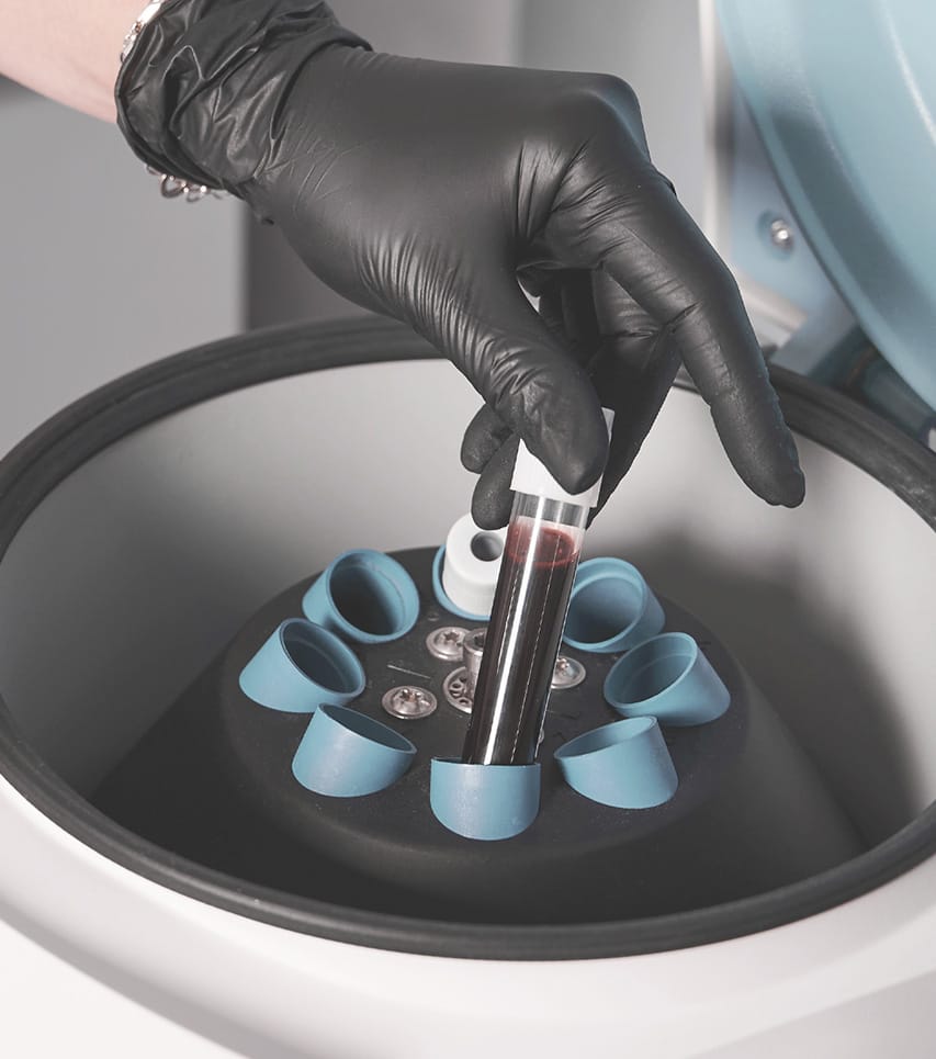Plasma Capilar - CLINICA ANTIENVEJECIMIENTO